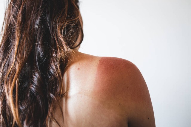 How to prevent sunburn - iNEWS