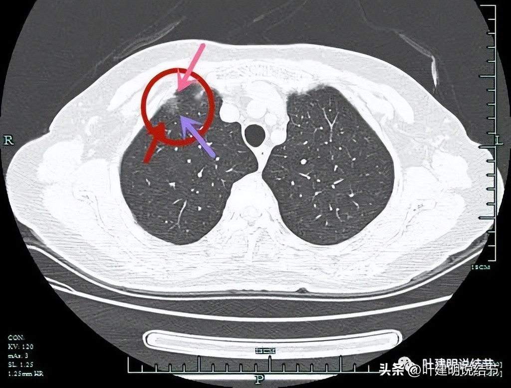 Such a typical ground glass nodule with invasive features (spiky sign ...