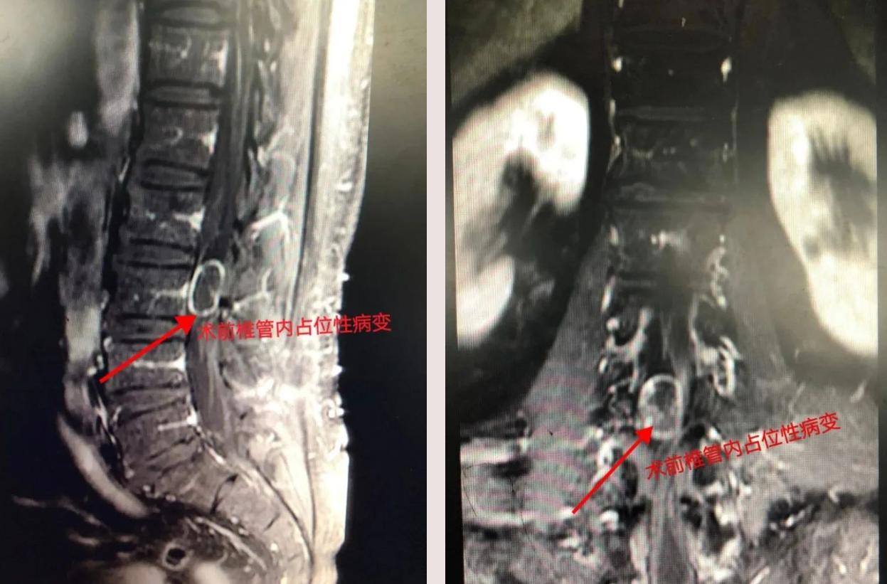 A man suffered from waist and leg pain for 4 months. He thought it was ...