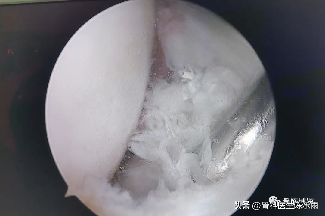 Anterior cruciate ligament insertion avulsion fracture arthroscopic ...