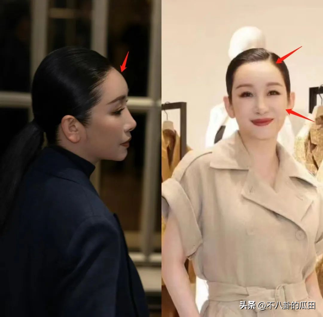 The star's face is swollen too terrible! With protruding forehead and ...