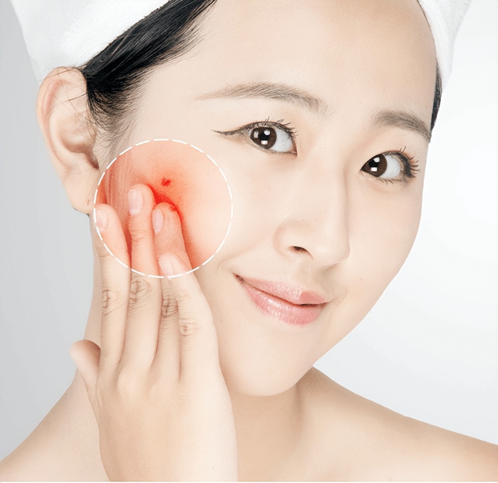 Cui Xue Fu: What's the matter with acne and itching? what can we do ...