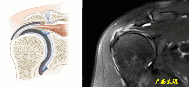 Diagnosis and Differentiation of Rotator Cuff Injury - iNEWS