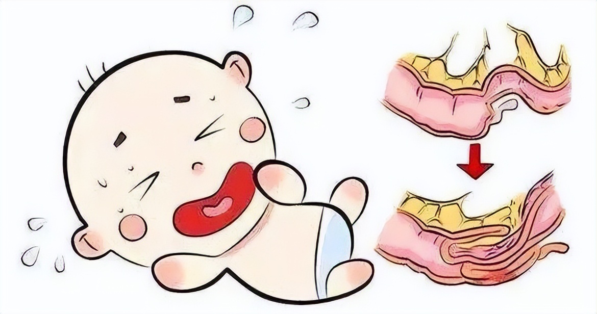 An 11-month-old boy suffered from intussusception, and the doctor ...