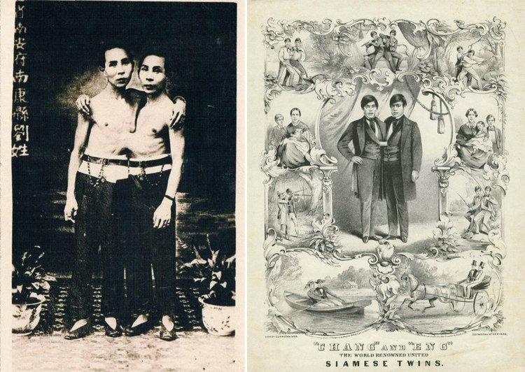 How do conjoined twins get married and have children? Thai conjoined ...