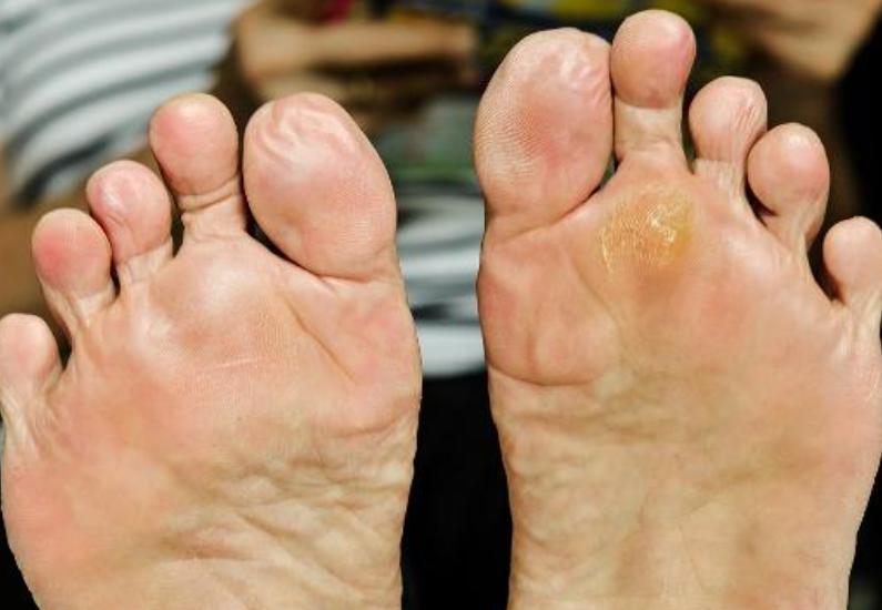 Bad liver, foot prophet?If the feet send out 4 kinds of signals, it is ...