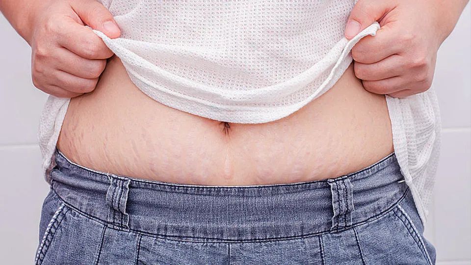 Stretch mark color battle, why is the color of stretch marks on my body ...