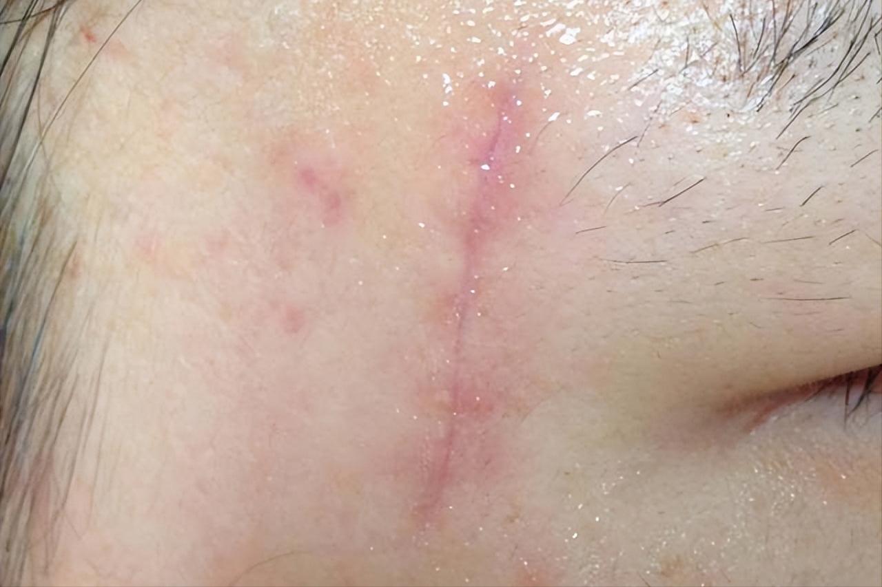 There are 7 types of common scars, which one are you? - iMedia