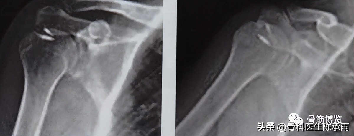 How to treat arthroscopic avulsion fracture of greater tuberosity of ...