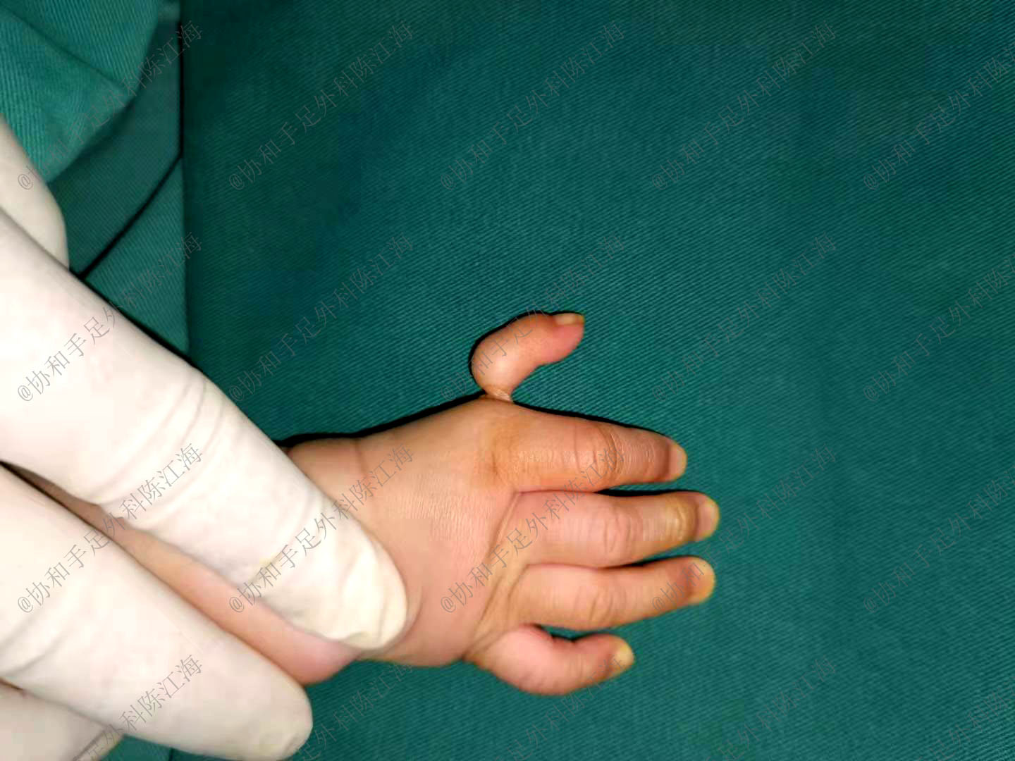 "My brother's hand is beautiful, I want to be the same as my brother's ...