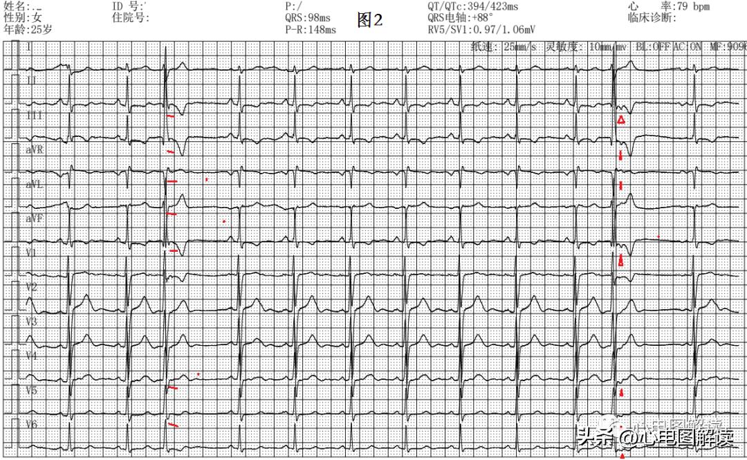 Ventricular premature beats, ventricular retrograde transmission?Atrial ...
