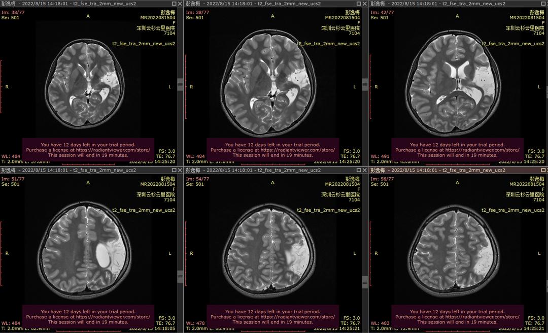 After saying "breakup" with epilepsy, the girl showed a long-lost smile ...