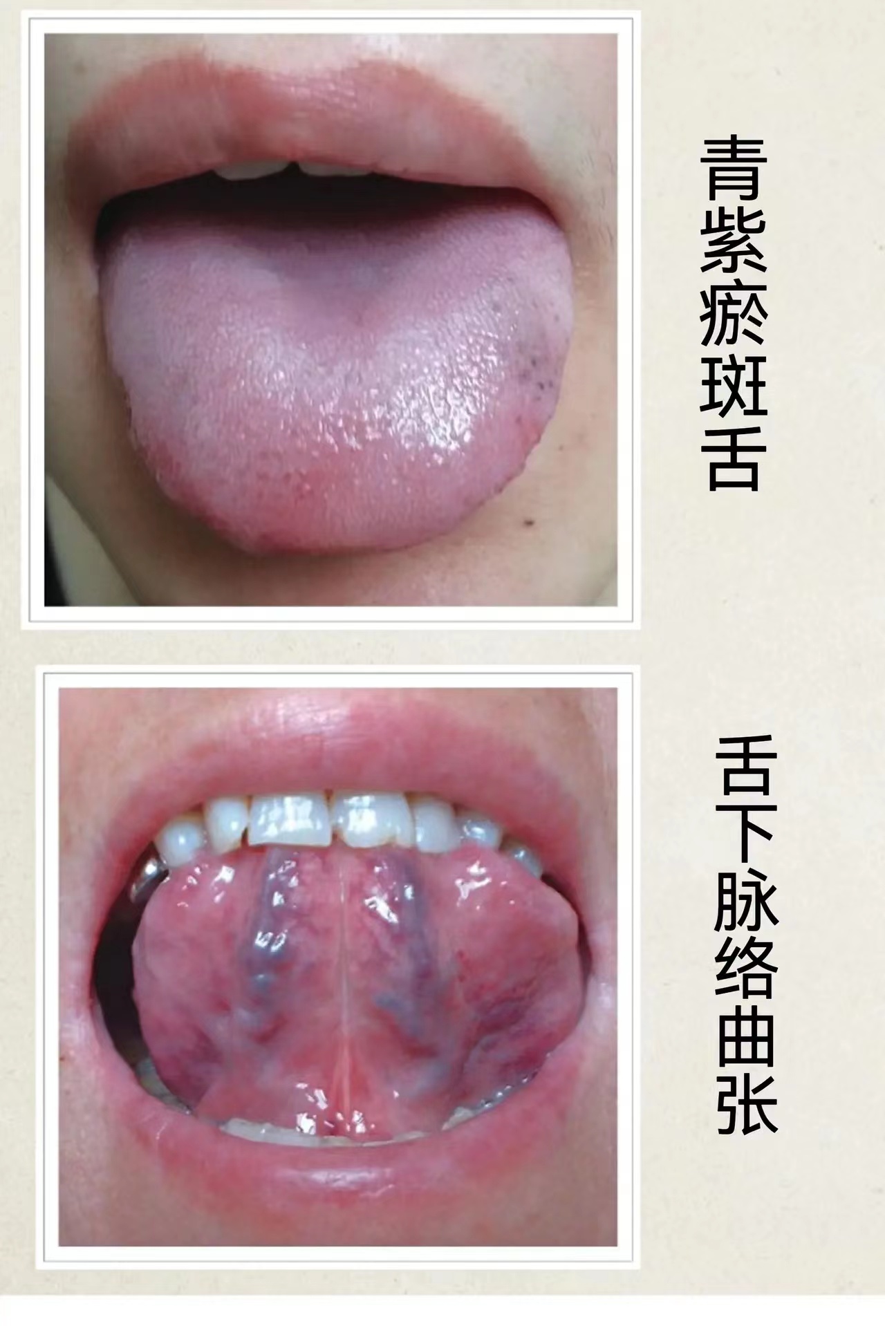 "Blood stasis suffers from all kinds of diseases", the "four stasis ...