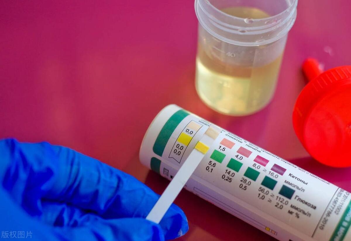 What do the "+" signs in urine routine mean? Teach you to read various ...