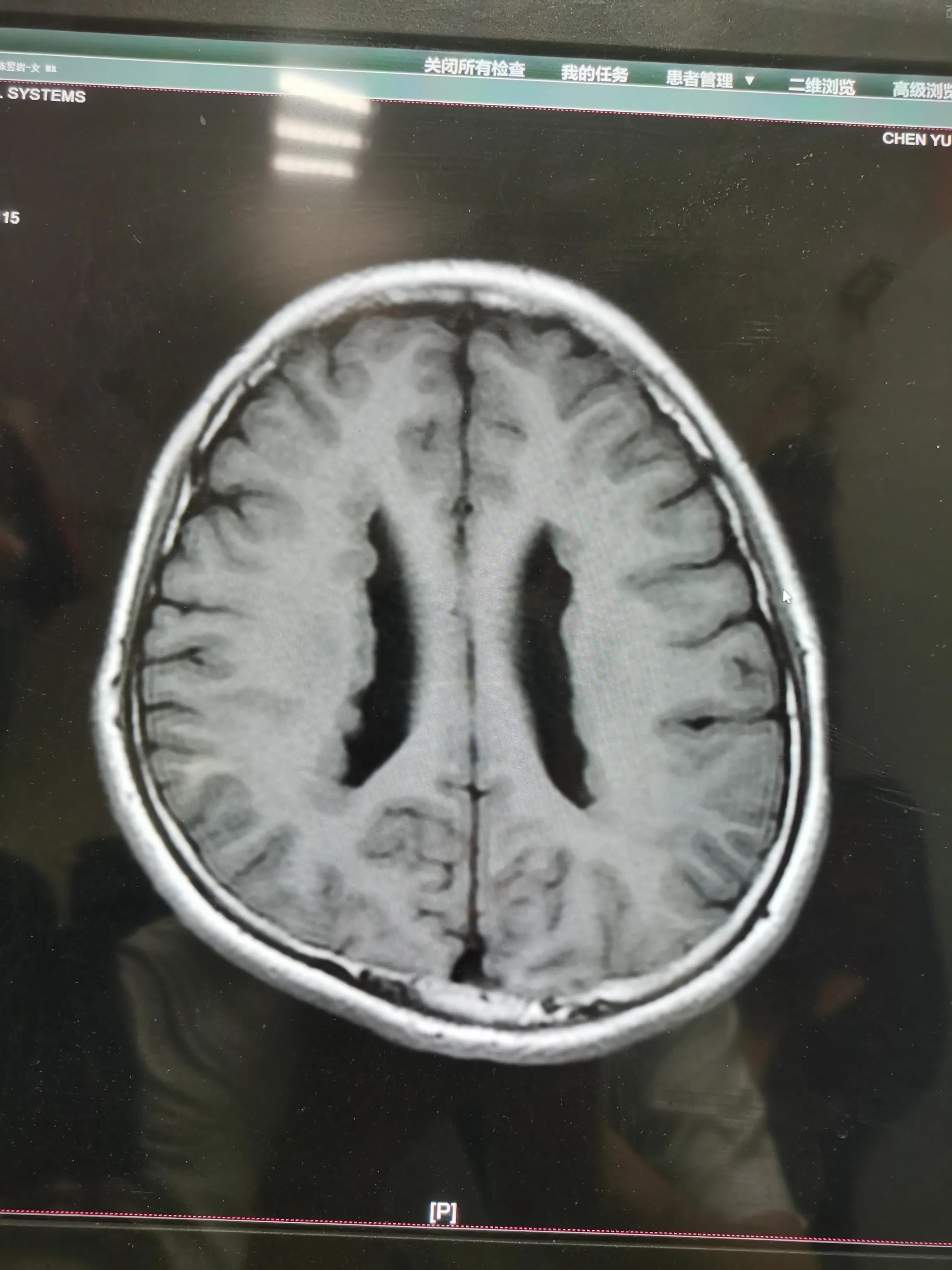 Classic image - gray matter heterotopia - iNEWS
