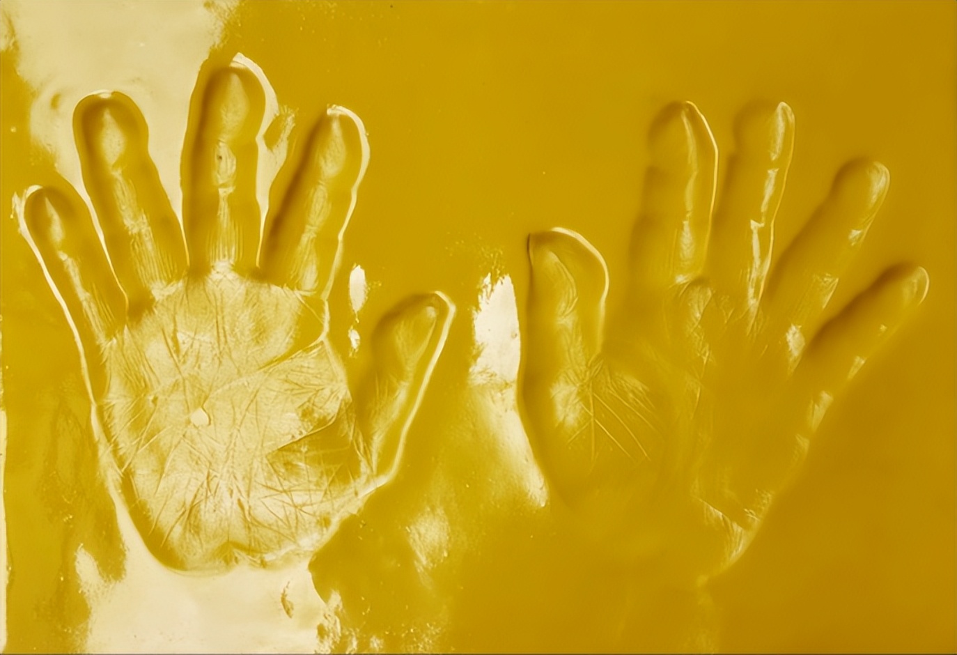 These deformed hands have done 16,000 operations - iNEWS