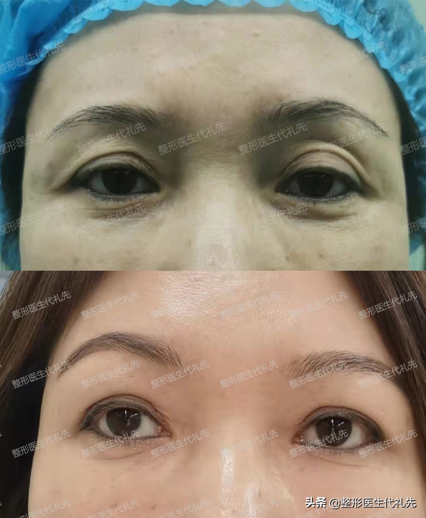 The doctor said: Do you choose fat or hyaluronic acid for eye socket ...