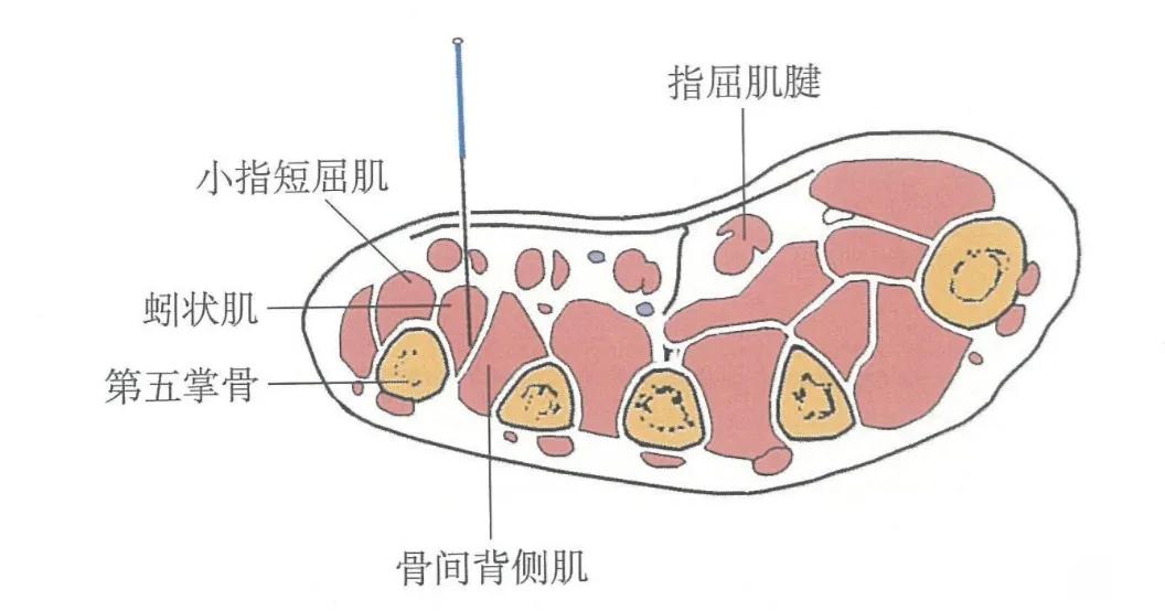 Learn one acupuncture point every day, Shaofu Point - iNEWS