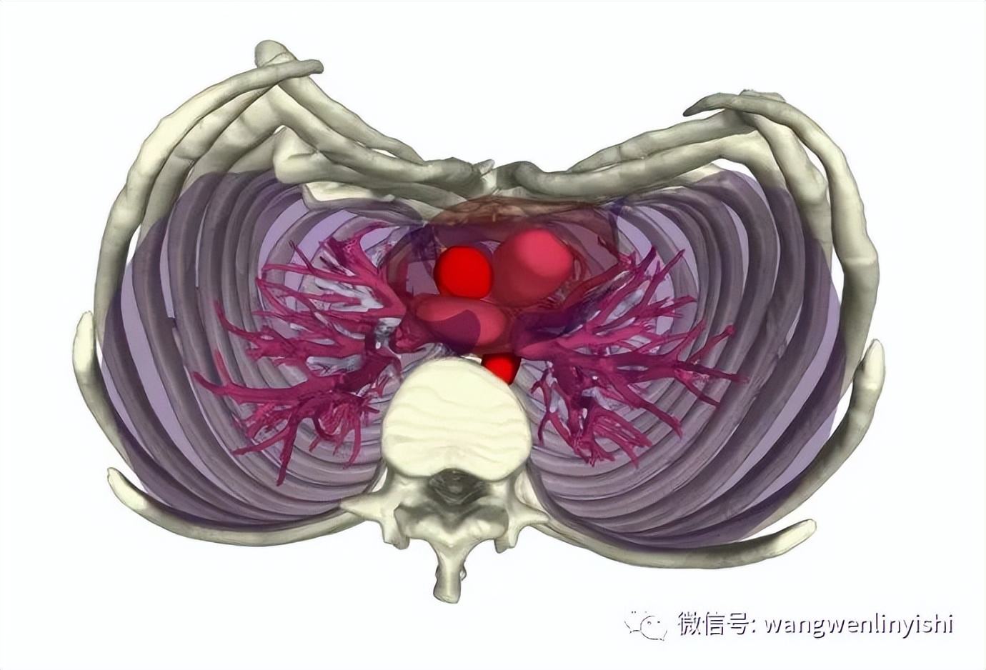 Pectus excavatum Ravitch surgery 20 years after surgery: Wung surgery ...