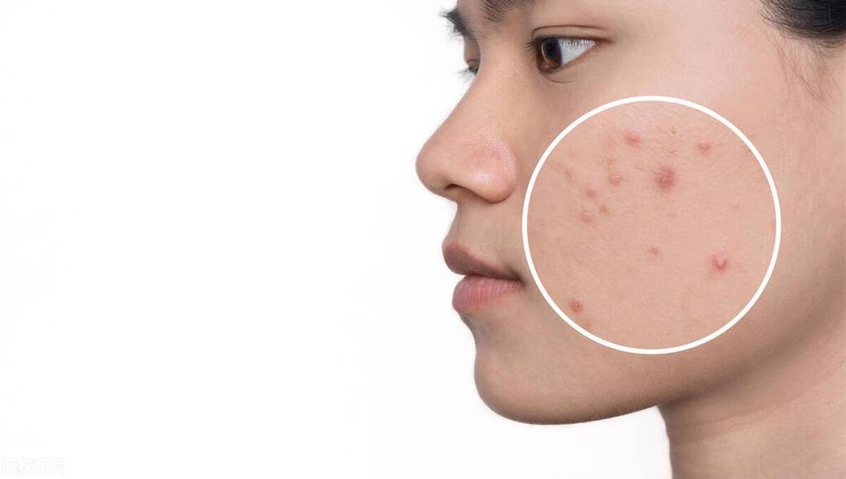 Facial acne has not disappeared for several years, what is the reason ...
