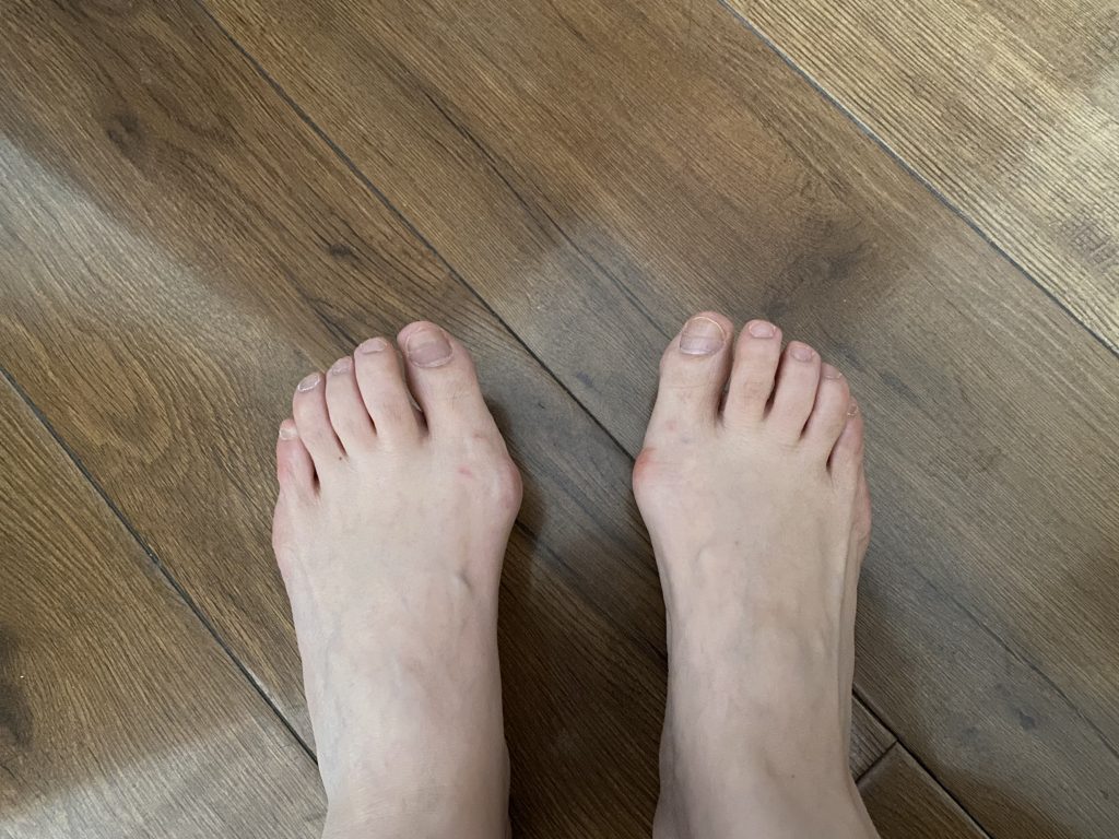 Hallux valgus usually painless to do surgery? What does bunion surgery ...