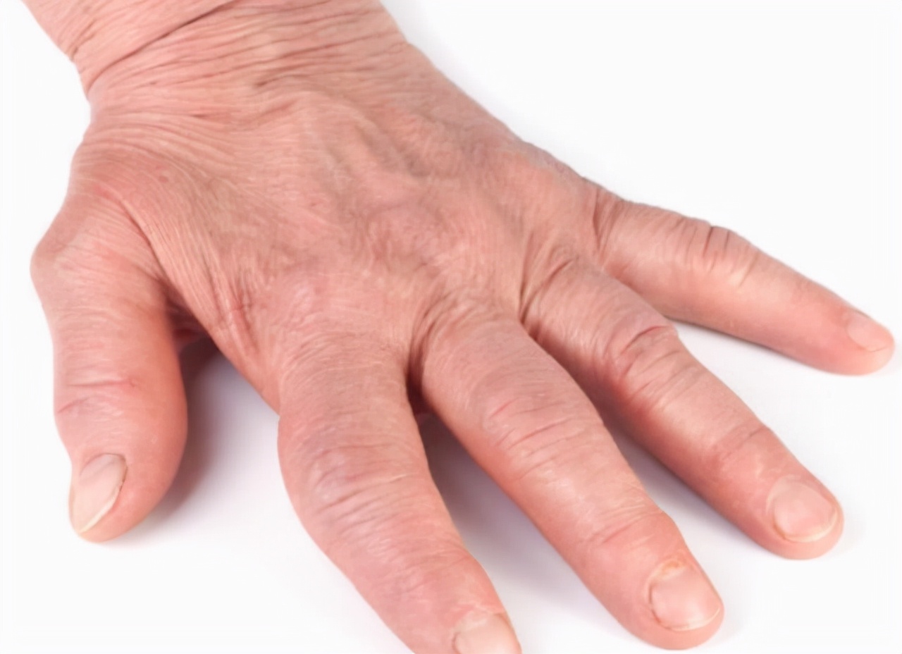 When uric acid is elevated, there may be 3 abnormalities in the hands ...