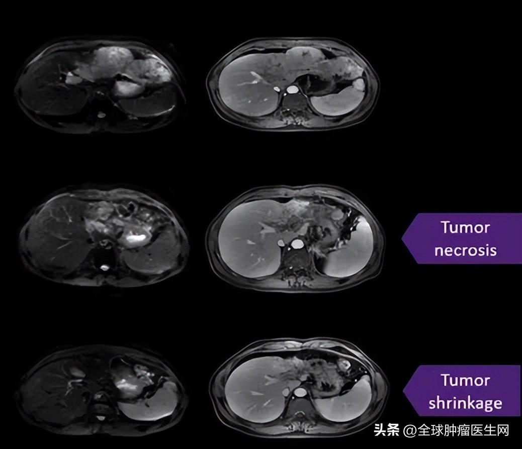 Challenge lung cancer, pancreas, liver cancer, sarcoma and other ...