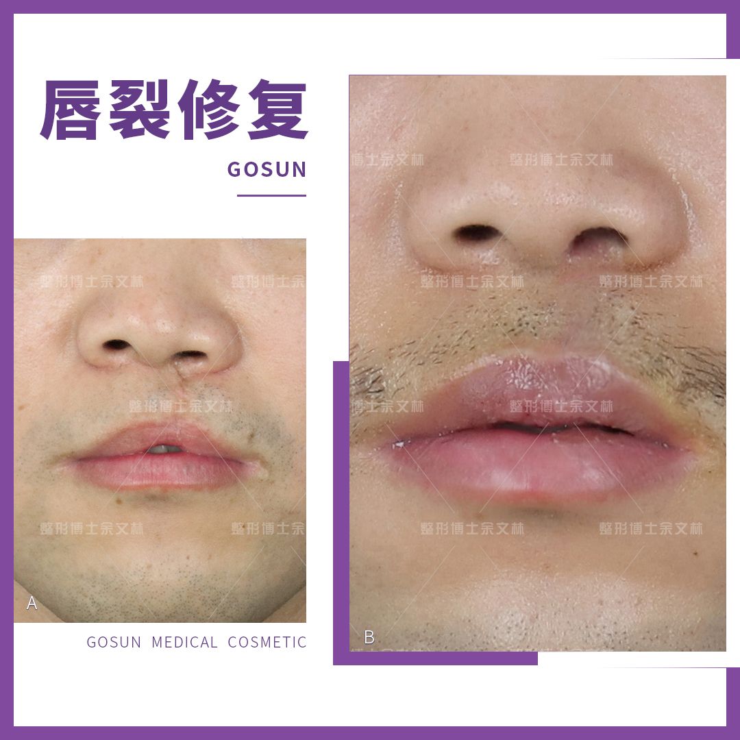 What should I do if a piece of lips is missing after Cleft Lip Repair ...