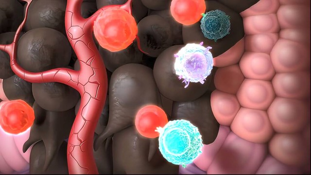 Uncover the mysterious law of lung nodule growth: These habits actually ...