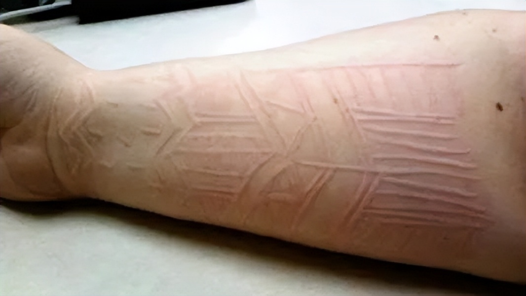 5% of people have this disease: can cut out a palace on the skin - iNEWS