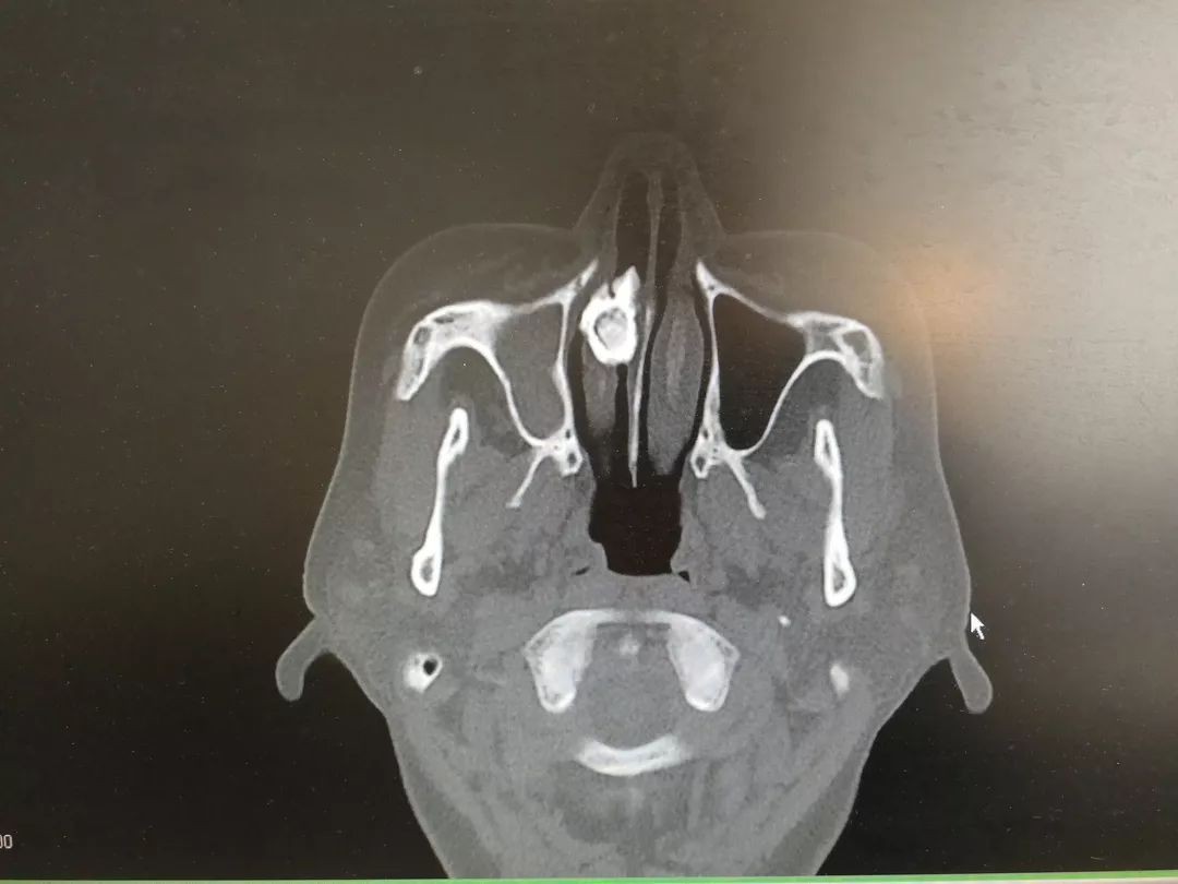 Small stones study the nasal cavity and sinus foreign body of the five ...