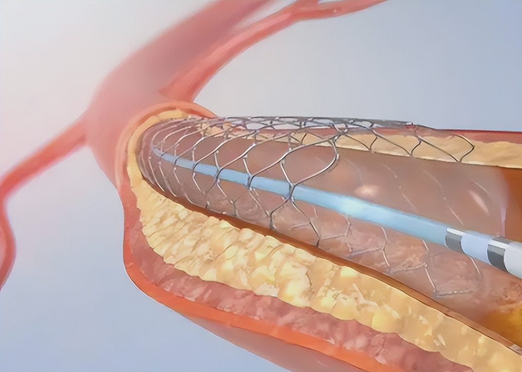 How many years can I live after a heart stent is installed? Pass it on ...