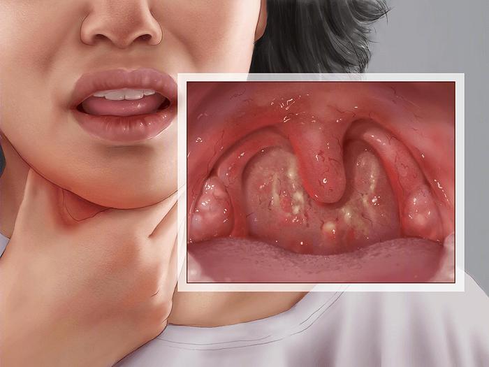 Chronic pharyngitis is difficult to cure, and you may not find the right cause - iNEWS