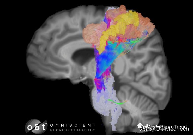 Approved by FDA! Decoding the Brain with AI - iMedia
