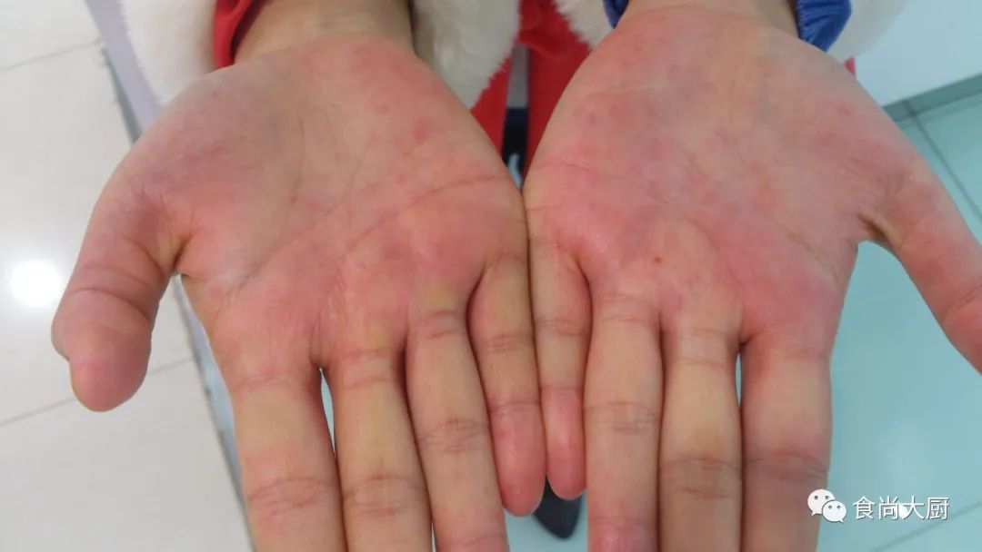 People with a long life span often have 3 "redness", indicating that ...