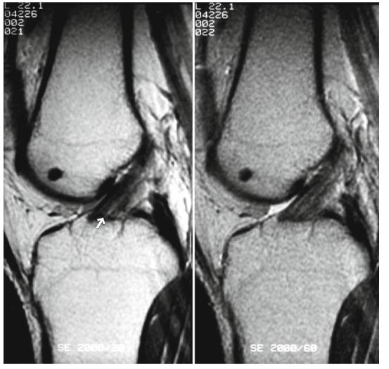 Confident Diagnosis - MRI ACL Torn - iNEWS