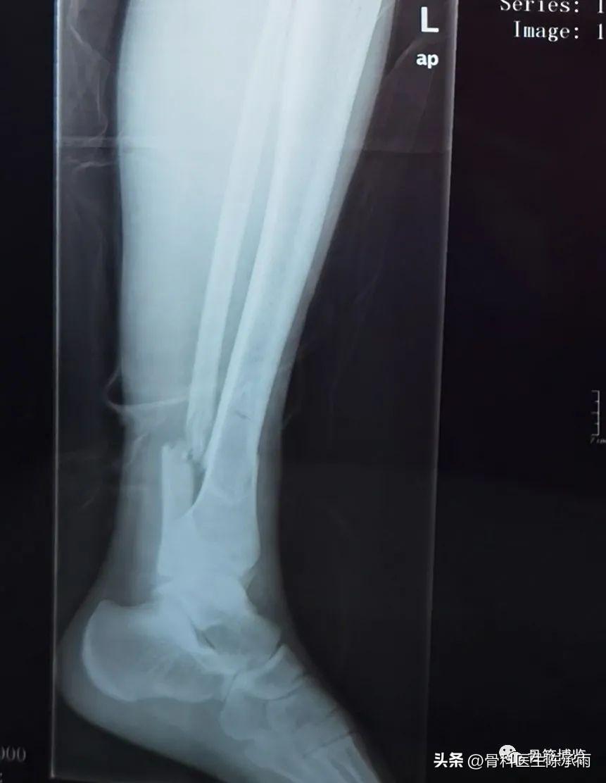 How to deal with poor skin conditions for distal tibia and fibula ...