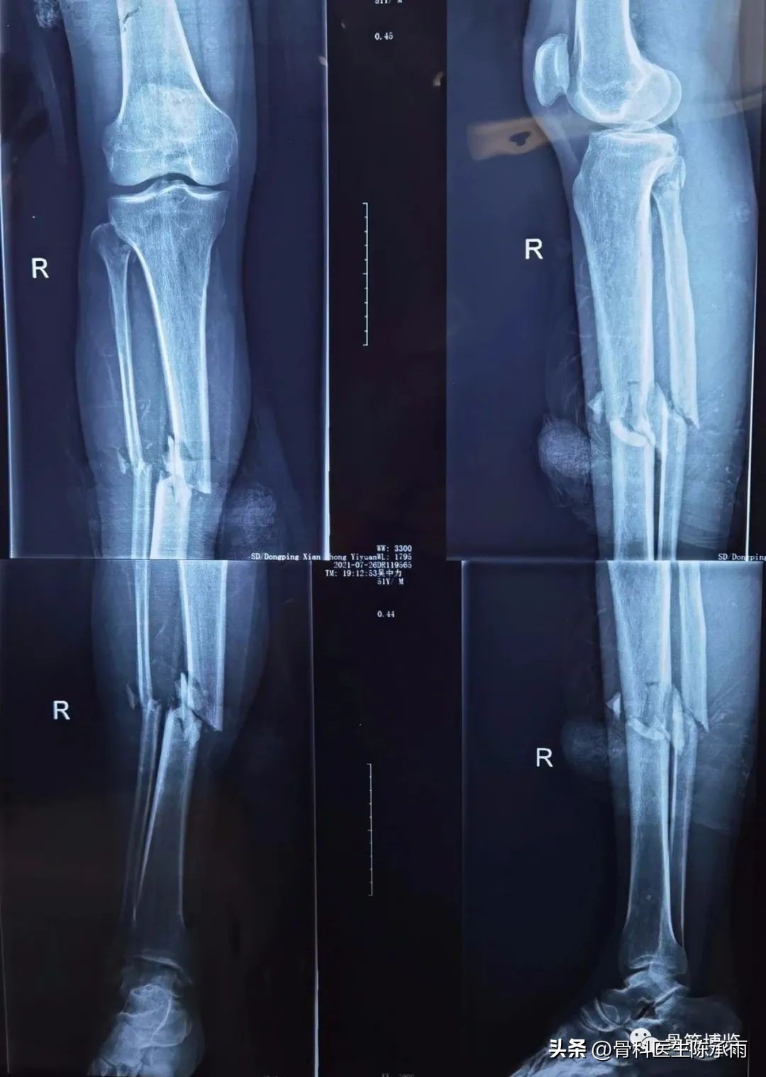 This week's tibial lock nails are available every day, seemingly simple ...