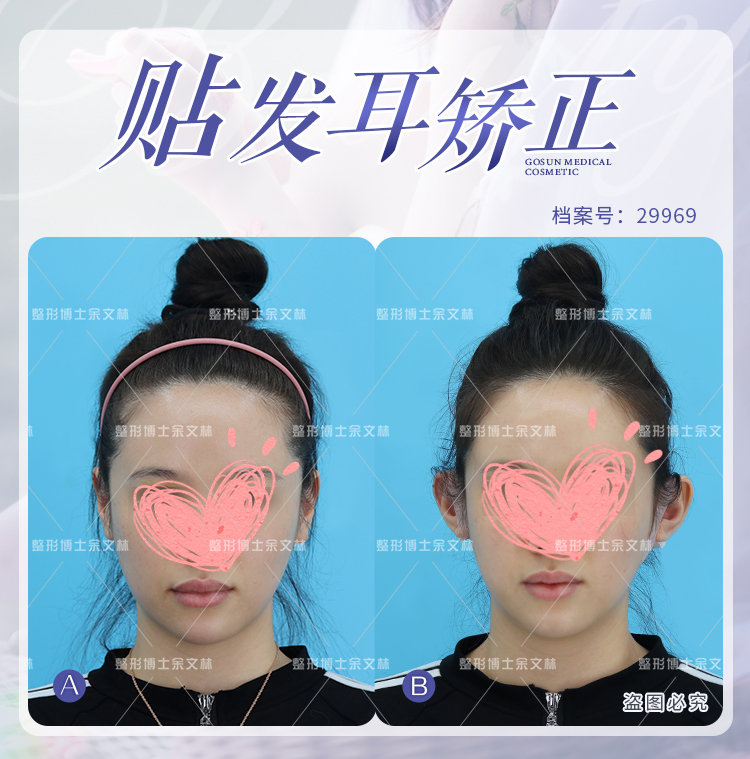 "Putting the ear" just adjusts the lower cranial ear angle?Just like ...