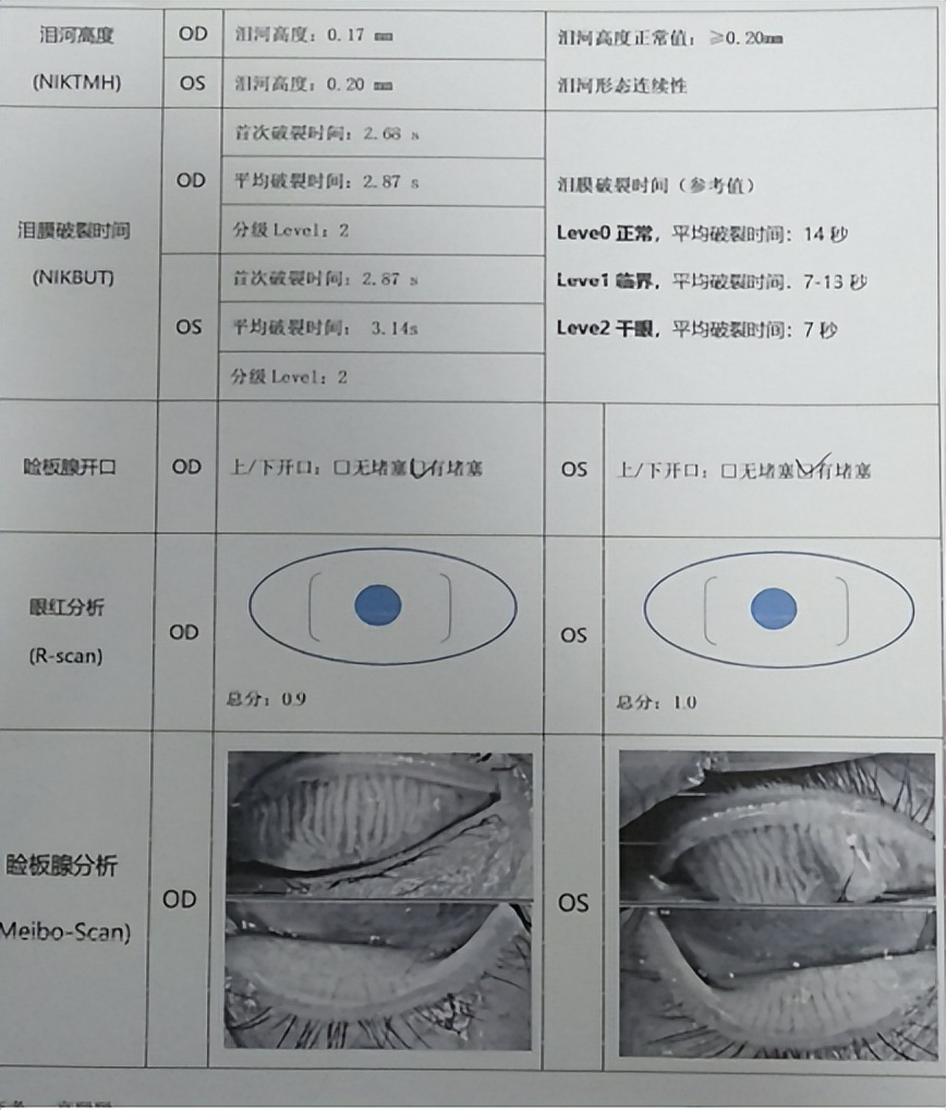 Dry eyes and strong foreign body sensation - iNEWS