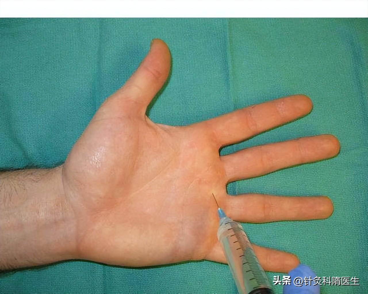 What is stenosing tenosynovitis?Where does it often happen?How to treat ...