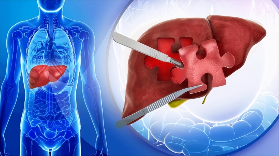 Don't give up easily in advanced liver cancer, this new therapy may ...