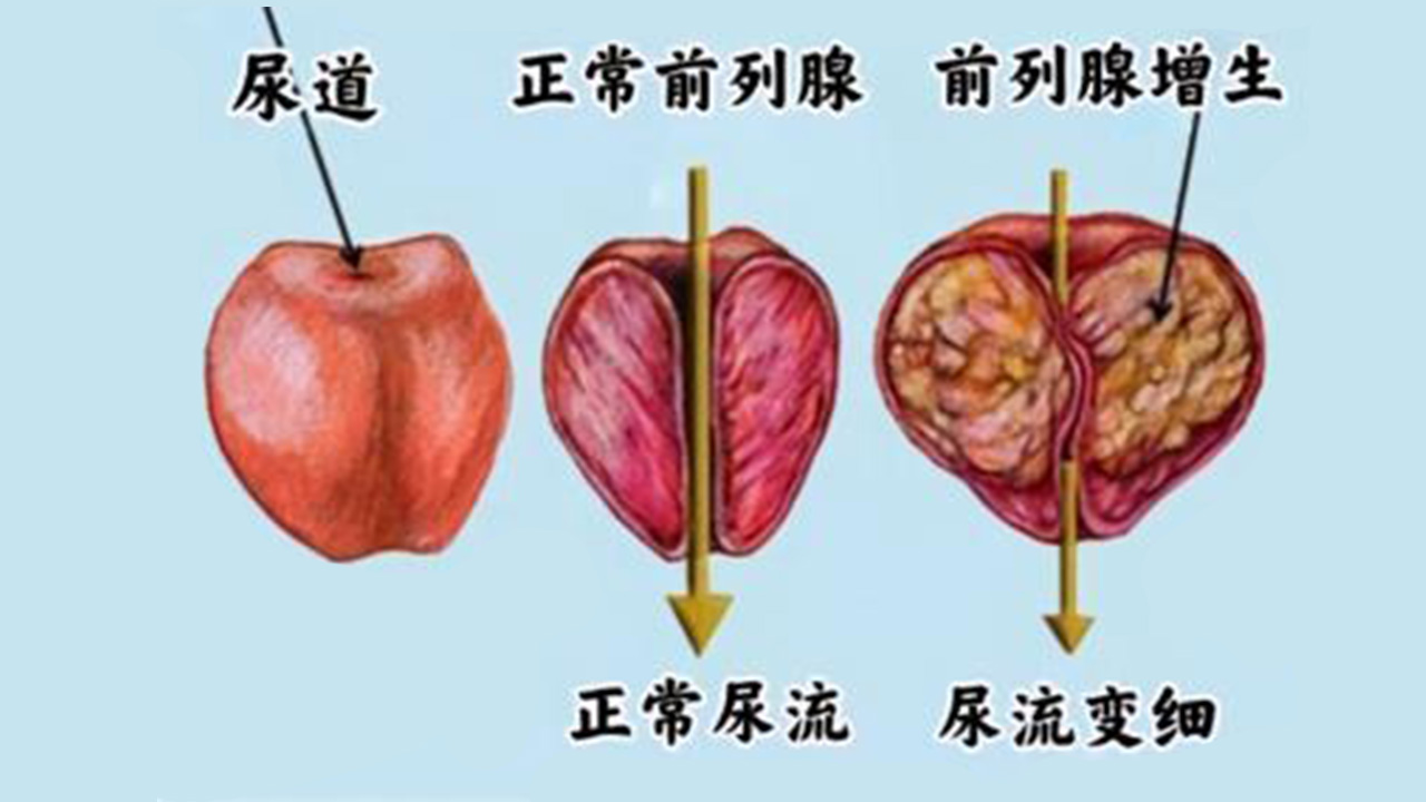 Tamsulosin, a urology medicine?Long-term use also has side effects ...