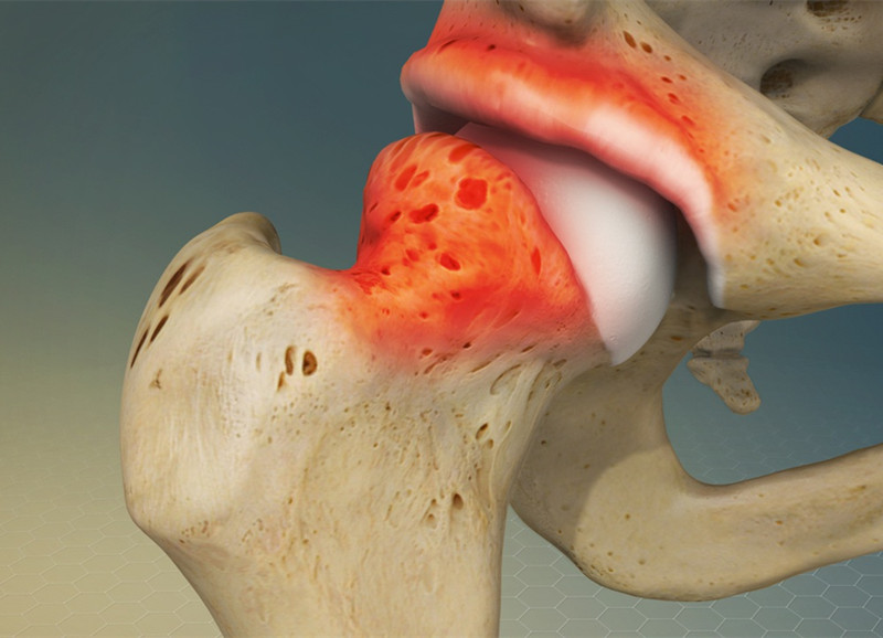 Butt pain, thigh root pain has not been cured, half of the patients ...