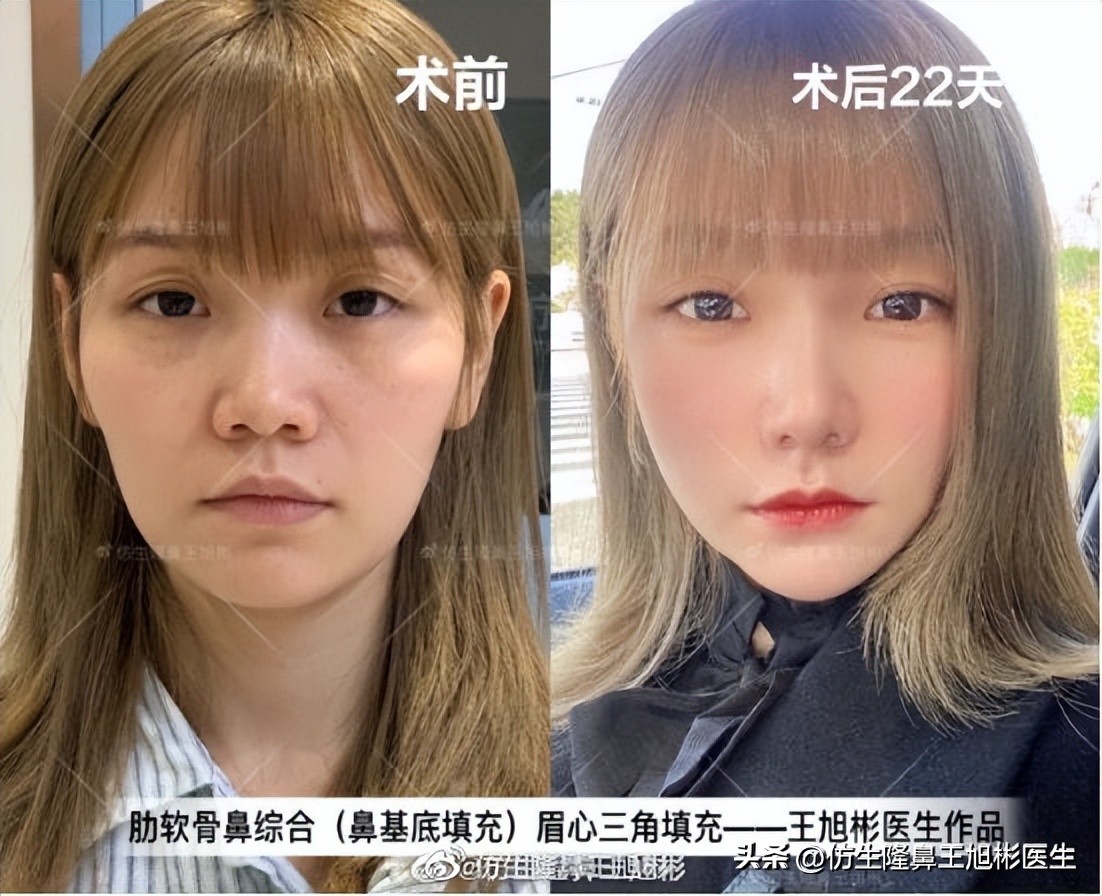 What are the factors that affect nasal alar hypertrophy?Can it be ...