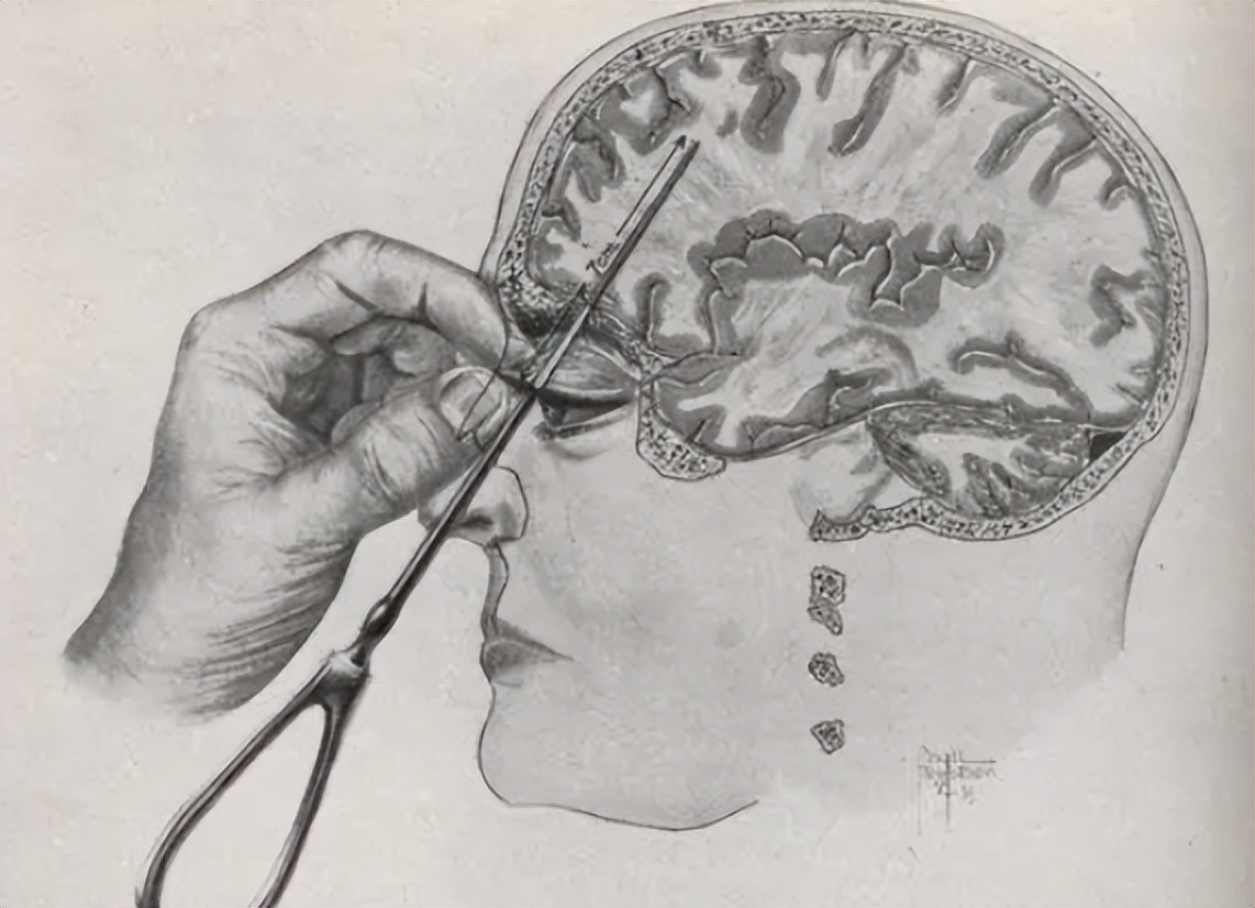 How was mental illness treated in the nineteenth century?lobotomy - iNEWS