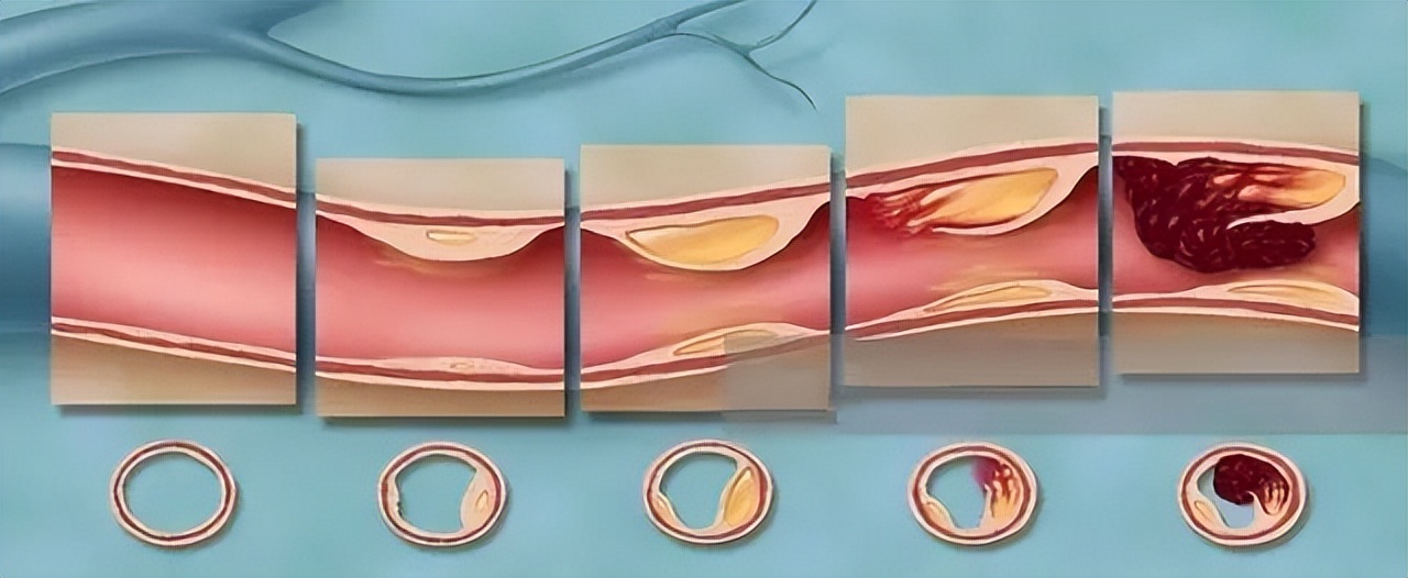 Are blood clots and plaque the same thing?The doctor made an image ...