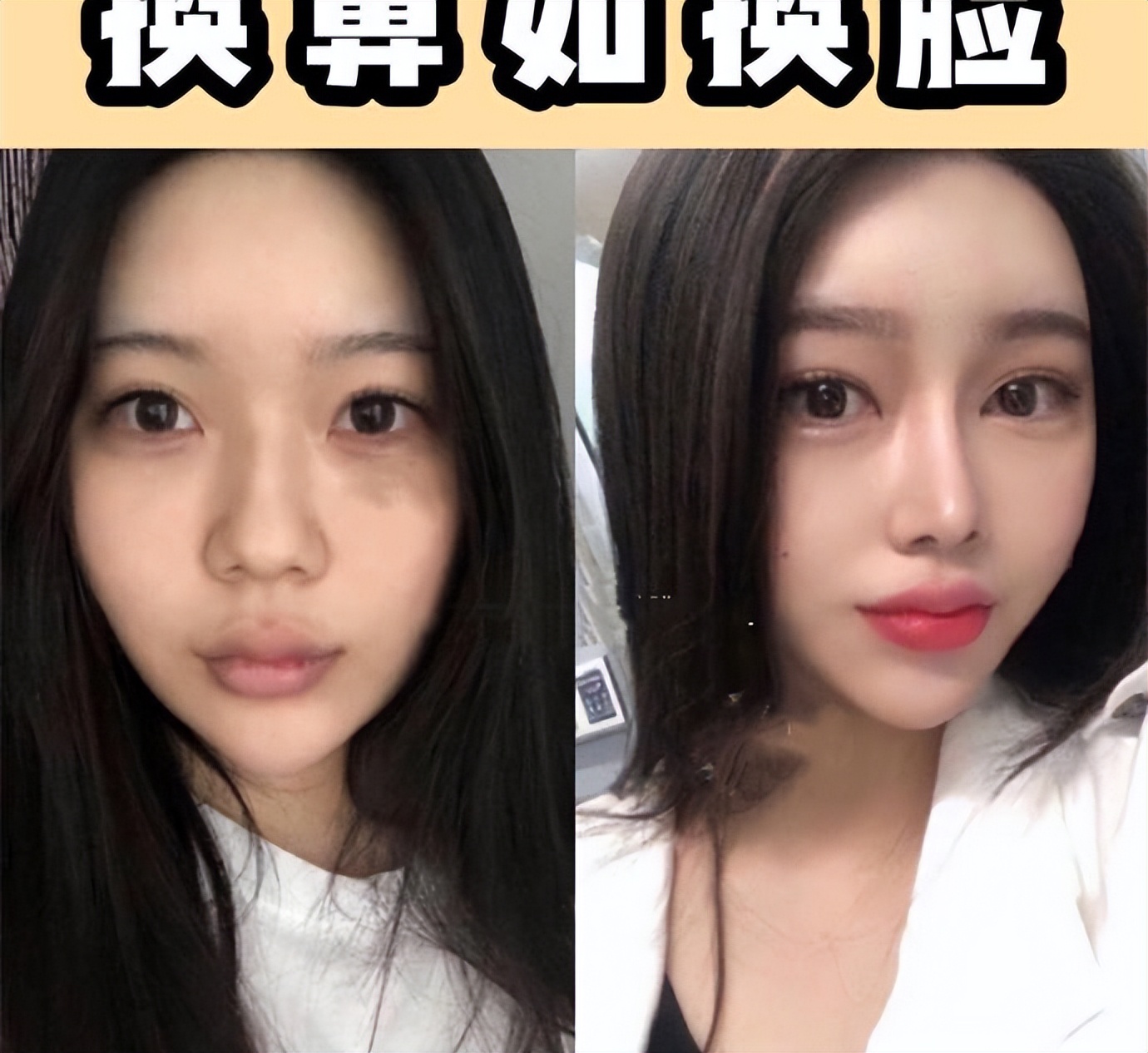 What is the experience of failing rhinoplasty?How soon can it be ...