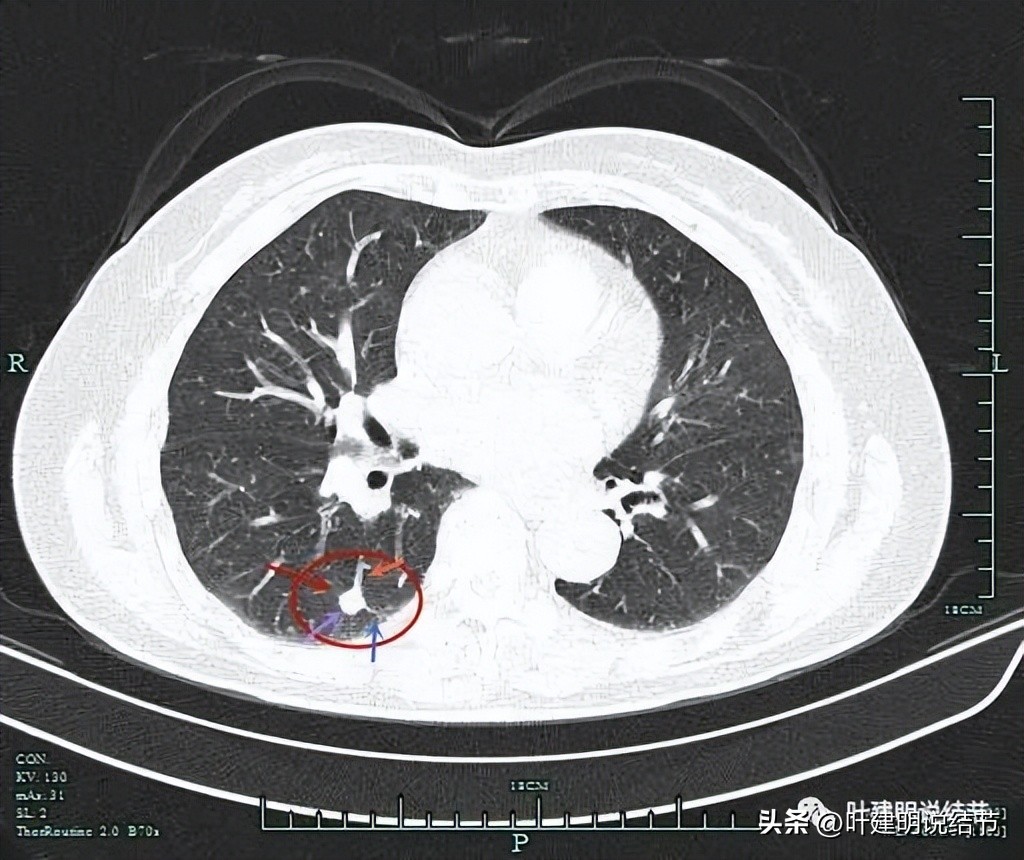 Why is such a solid nodule with vascular signs, burrs and pleural ...