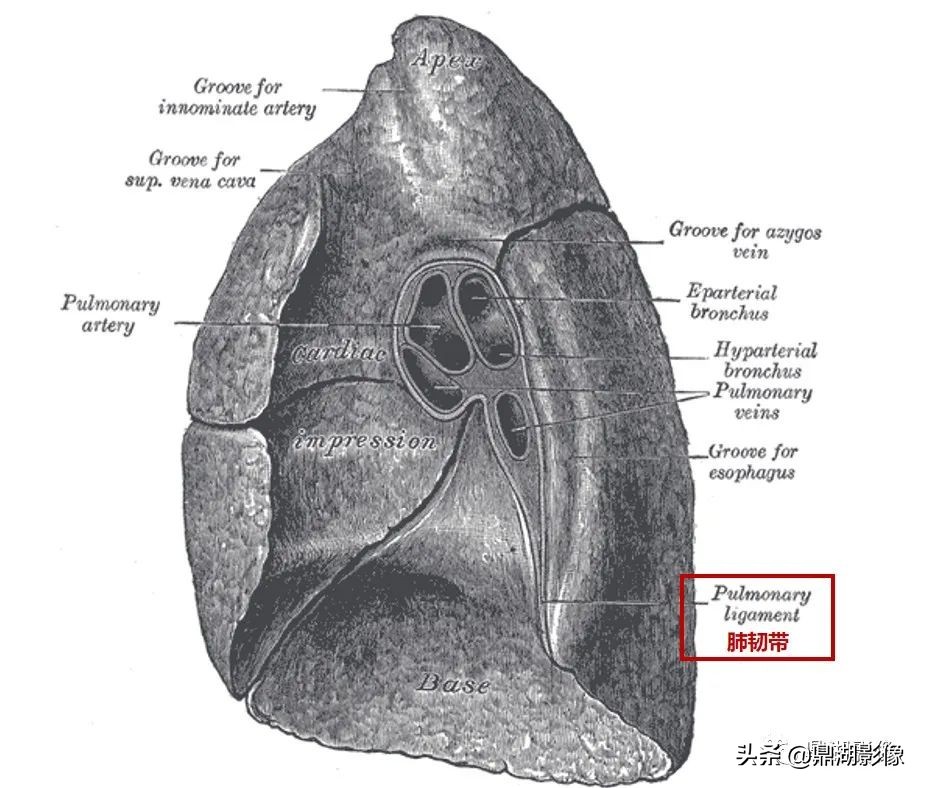 "Pulmonary ligament" on chest CT, stop reporting fibrous cords - iNEWS